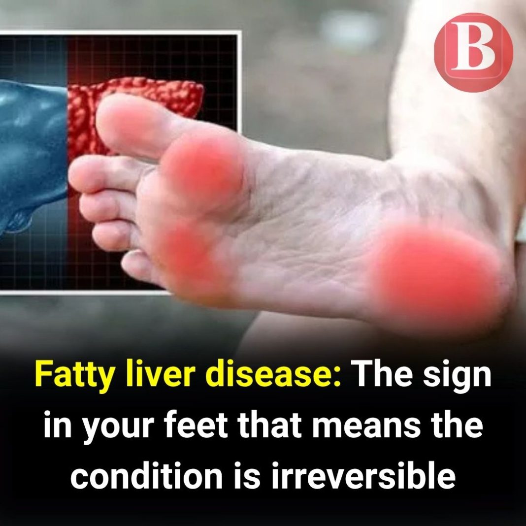 Fatty liver disease: The sign in your feet that means the condition is ...