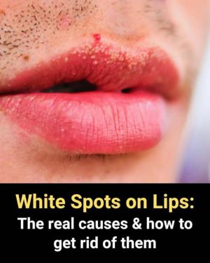 WHAT ARE THE WHITE BUMPS ON YOUR PRIVATE PARTS — AND SHOULD YOU BE ...
