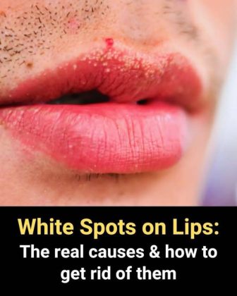 WHAT ARE THE WHITE BUMPS ON YOUR PRIVATE PARTS — AND SHOULD YOU BE ...