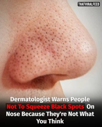 Dermatologist Warns Against Squeezing Black Spots On Your Nose Because ...