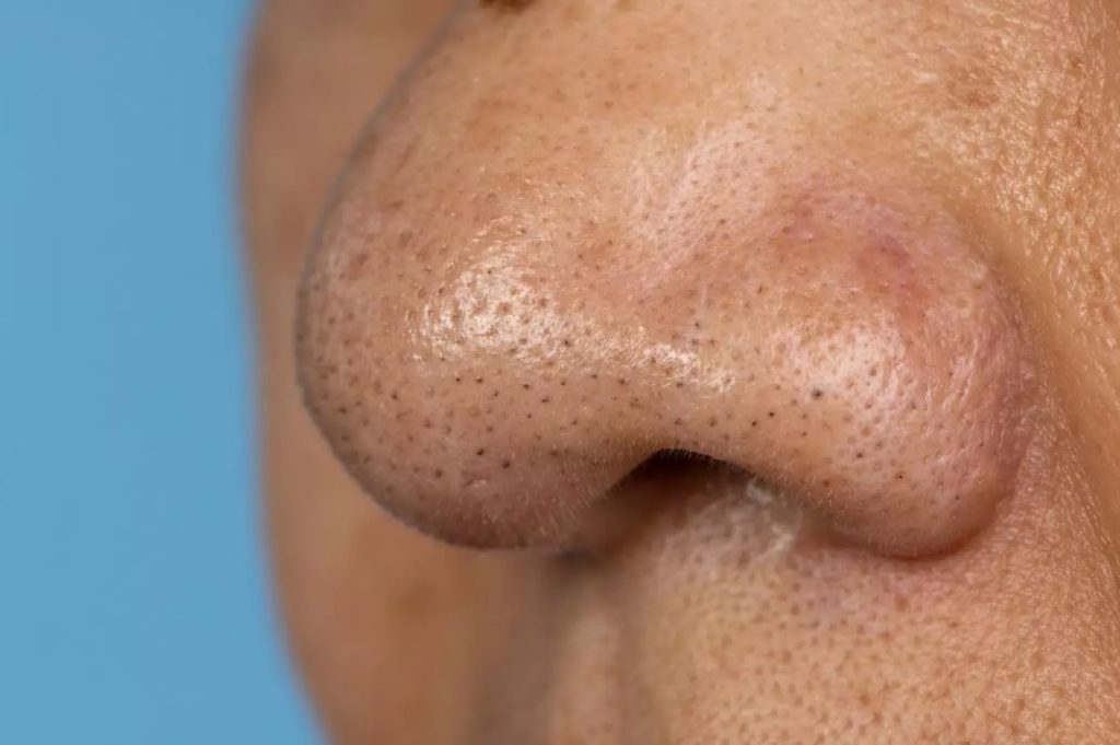 Dermatologist Warns Against Squeezing Black Spots On Your Nose Because ...